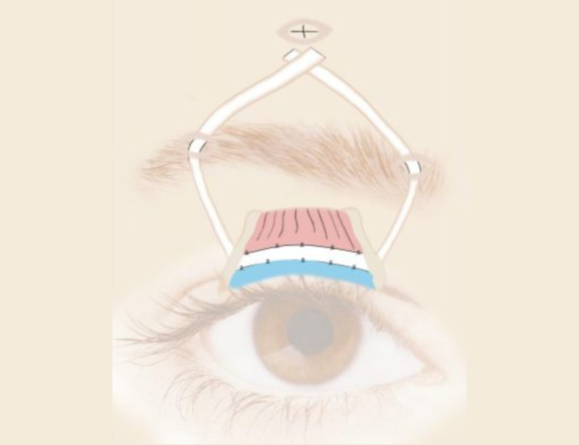 Ptose-up® - FCI