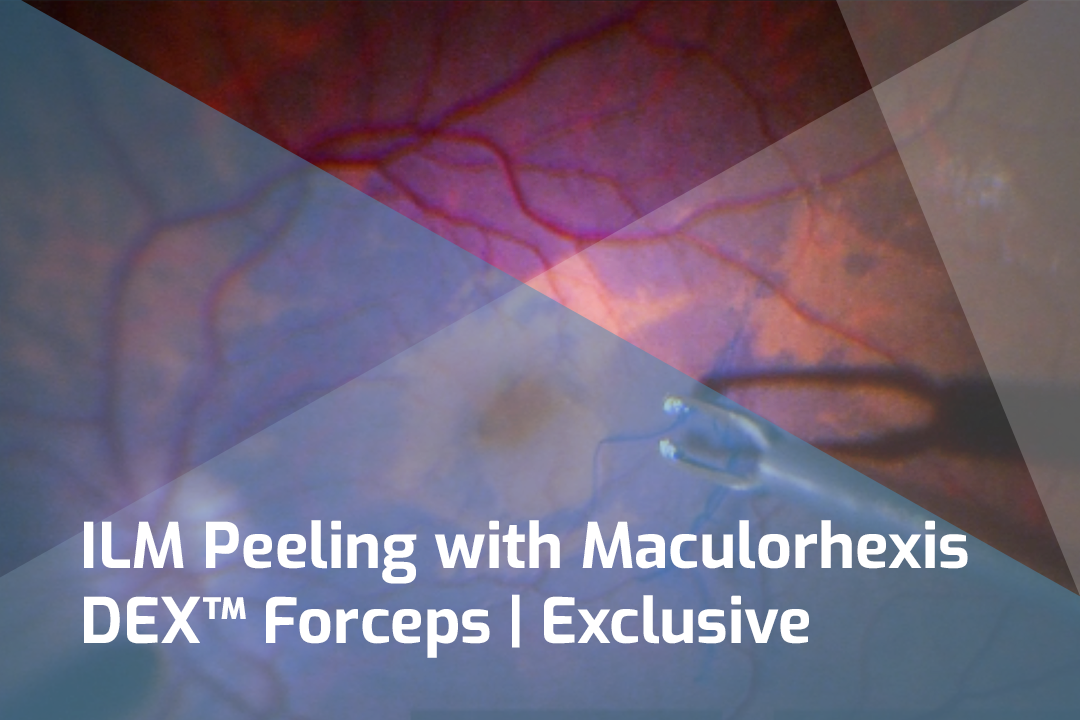 New Video | Maculorhexis DEX™ Forceps - FCI