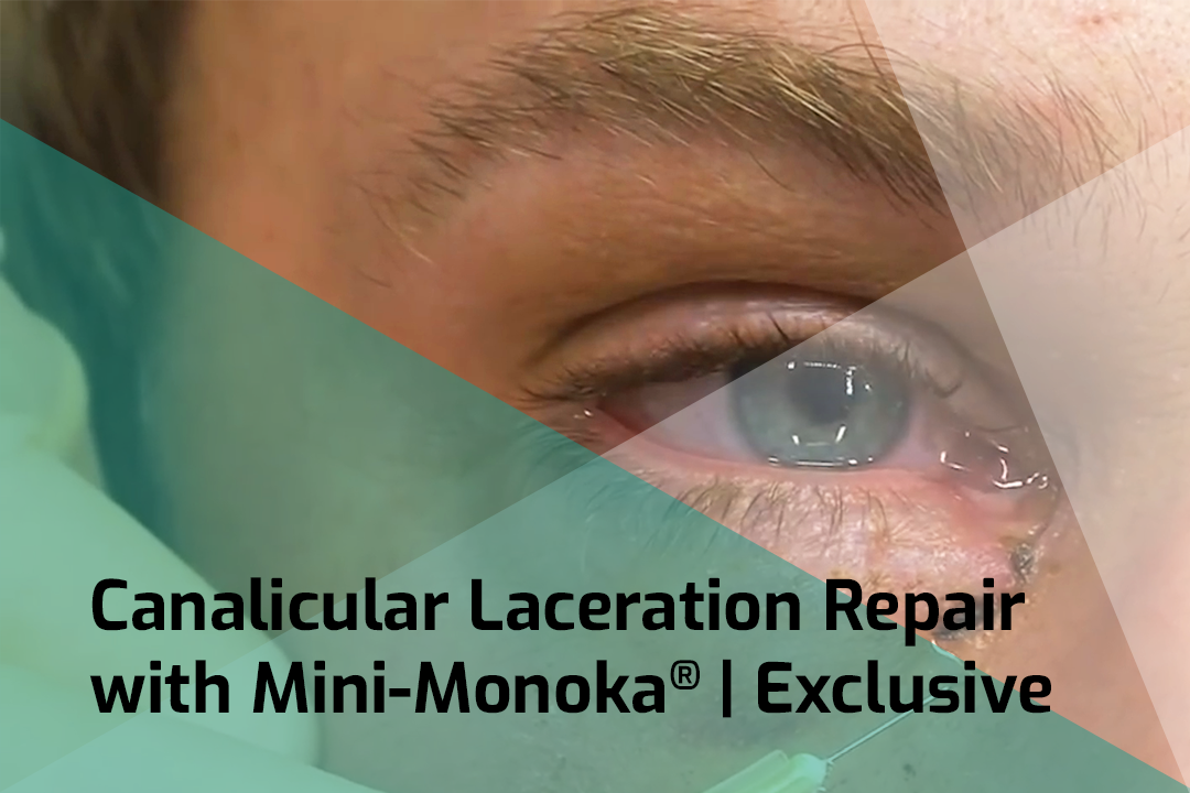 New Video | FCI’s Mini-Monoka® - FCI